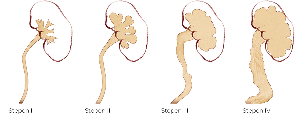 Hidronefroza | Dečija urologija | Andromedic Akademija Beograd